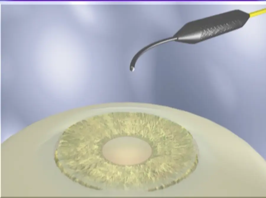 Endo Laser ECPC - Endoscopic CycloPhotocoagulation - Dan Scott and ...