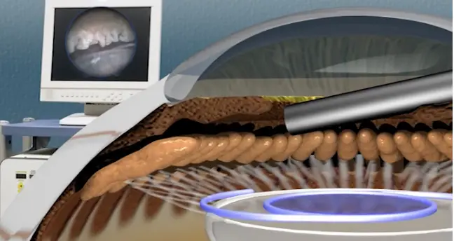 Endo Laser ECPC - Endoscopic CycloPhotocoagulation - Dan Scott and ...